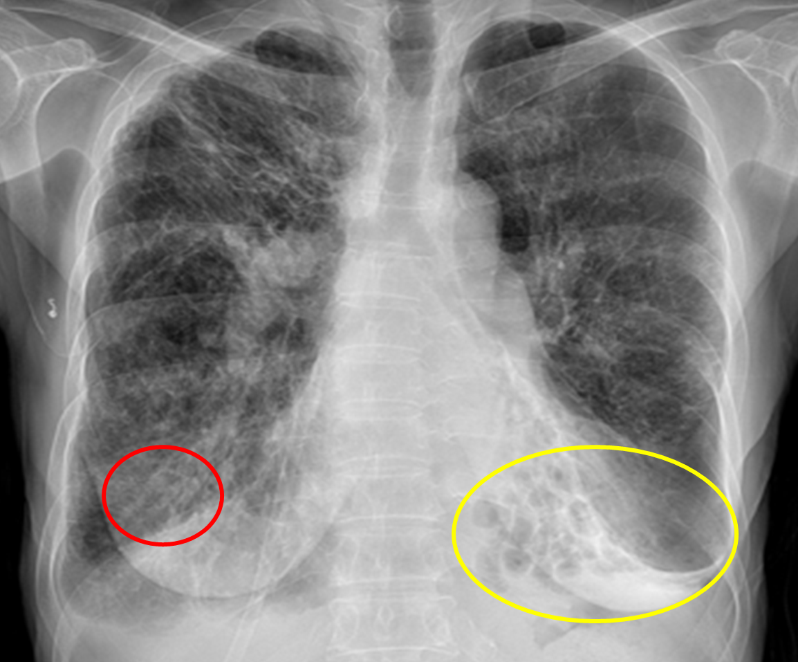 23번에서 가슴x선 reticular nodular pattern, left lung fibrosis 그리고 가슴 CT에서 ...
