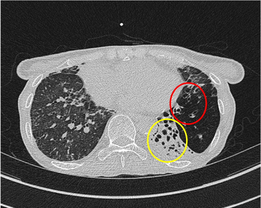 23번에서 가슴x선 reticular nodular pattern, left lung fibrosis 그리고 가슴 CT에서 ...