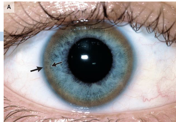 틈새등 눈검사 사진을 KF ring으로 판단하기엔 좀 애매하지않을까요? - 2020 KMLE 4교시 44번 | 메디톡