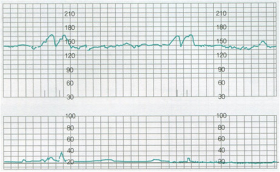 왜 이 nst 는 variable deceleration이 아니라 정상인가요? - 2017 PE 산부인과 1번 | 메디톡